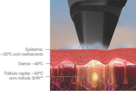 Soprano Ice Pratinum - Locato